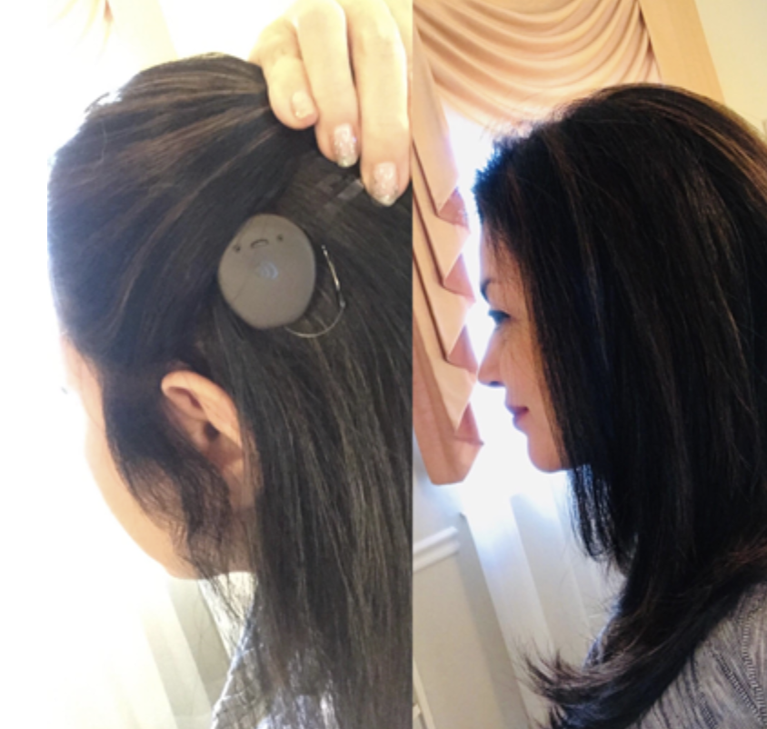 Invisible Cochlear Implants and Alternatives, Explained